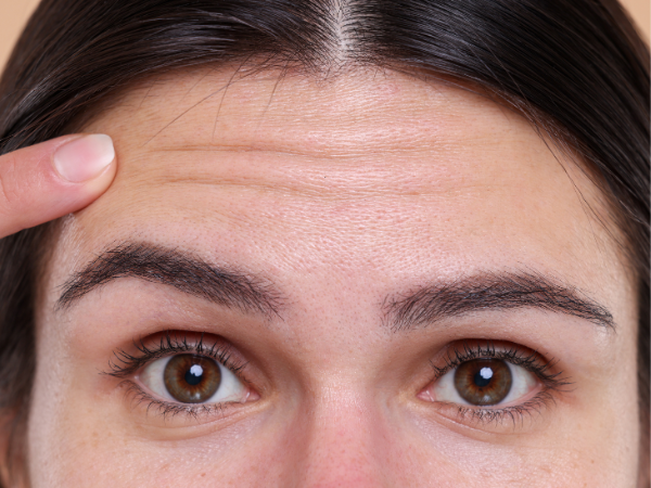 How to Calculate the Right Botox Units for Forehead Wrinkles - Elite ...