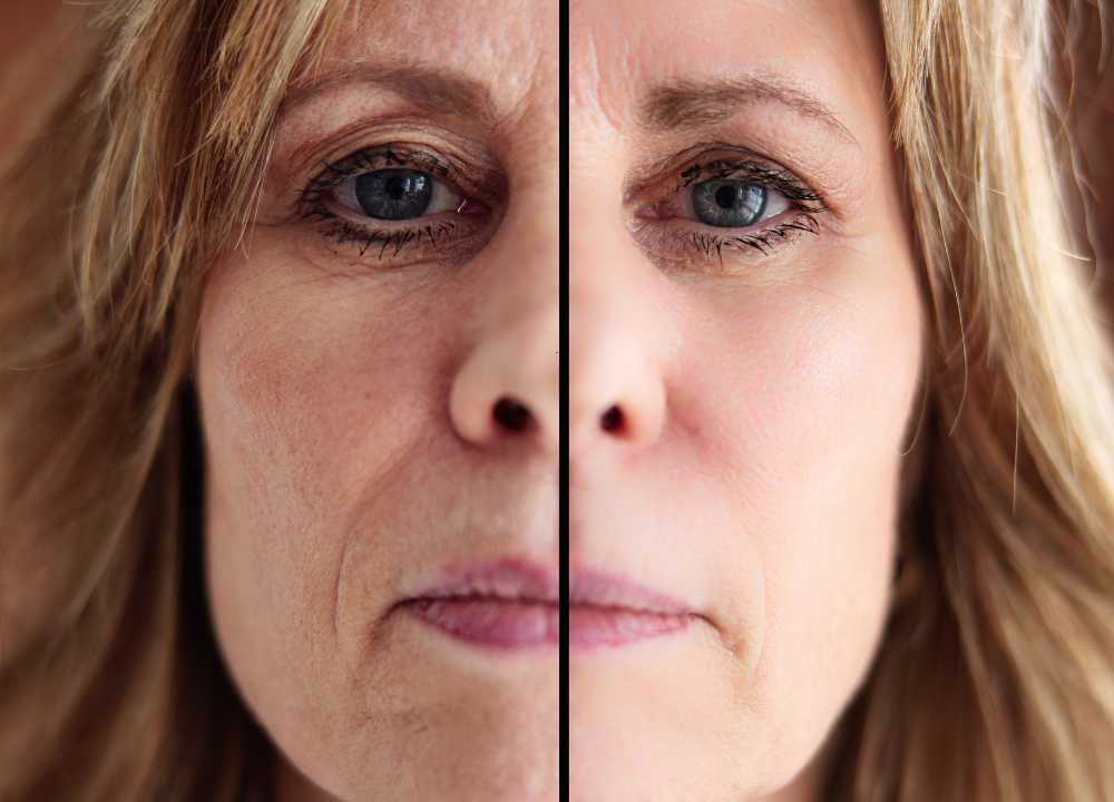 I Forgot and Laid Down After Botox: What Happens 2 my face Now? - Elite ...
