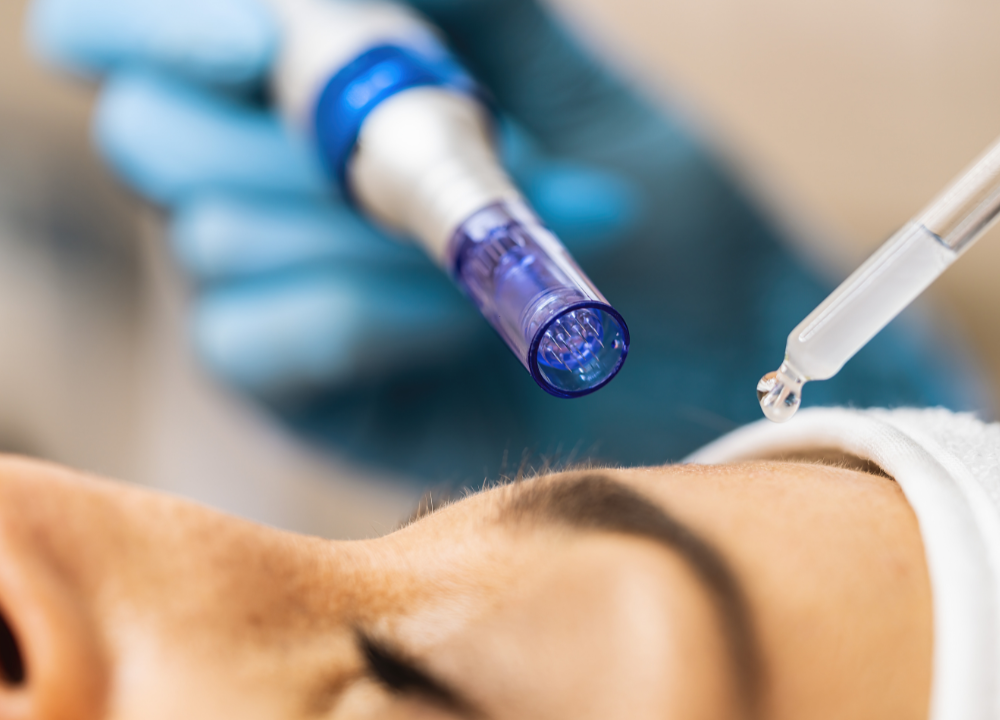 Understanding the Pain Factor in Microneedling: What to Expect – Elite ...